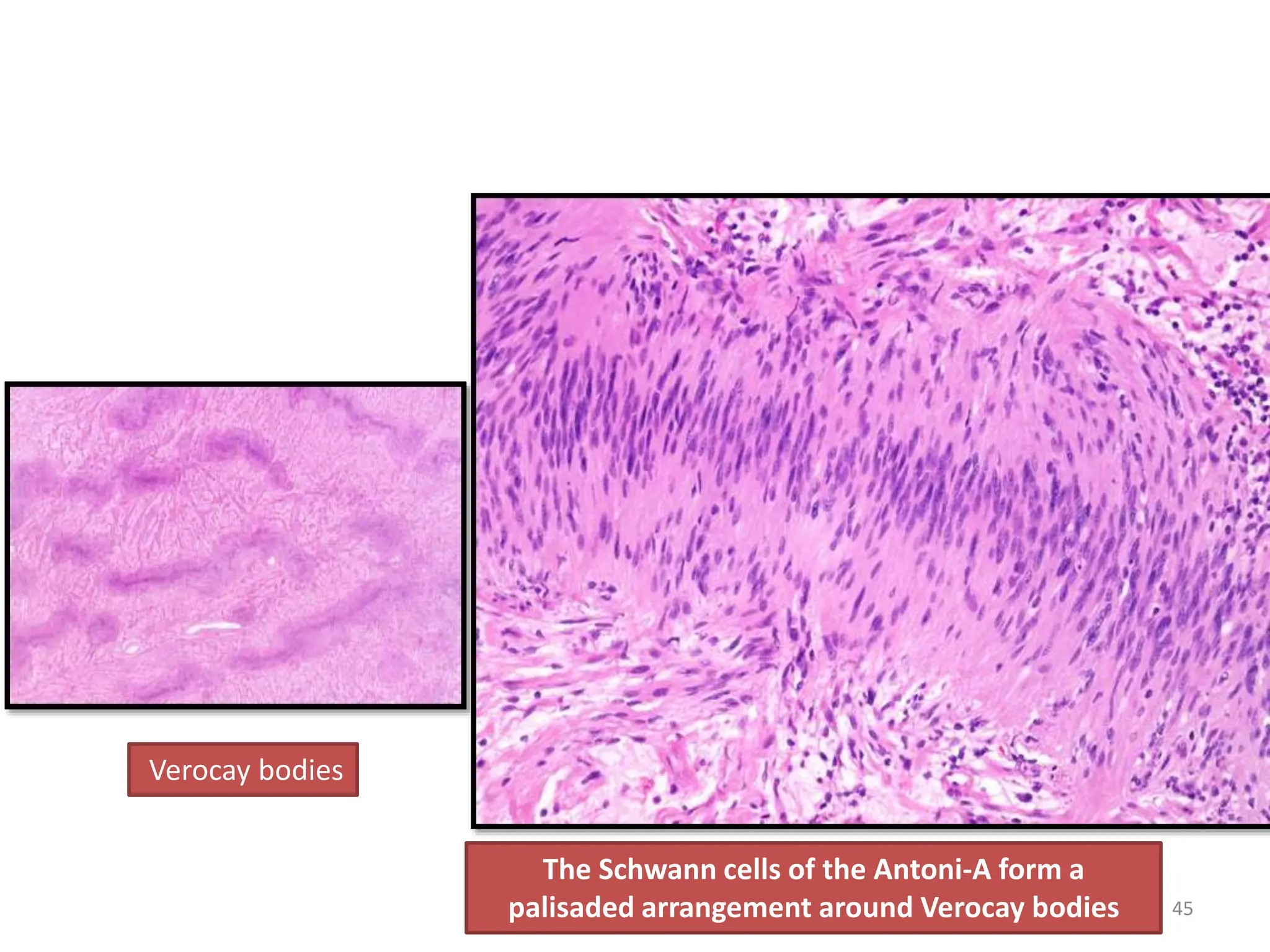 NEURAL TUMORS involving the oral and maxillofacial pathology | PPTX