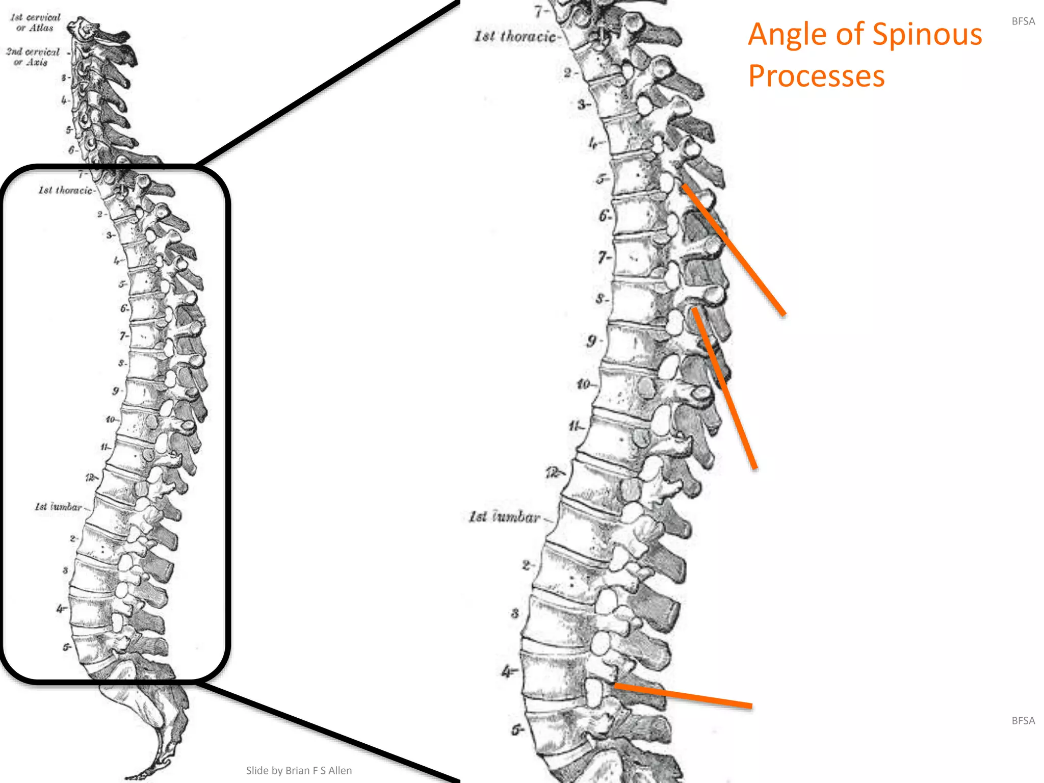 Neuraxial and Truncal Regional Anesthesia | PPTX