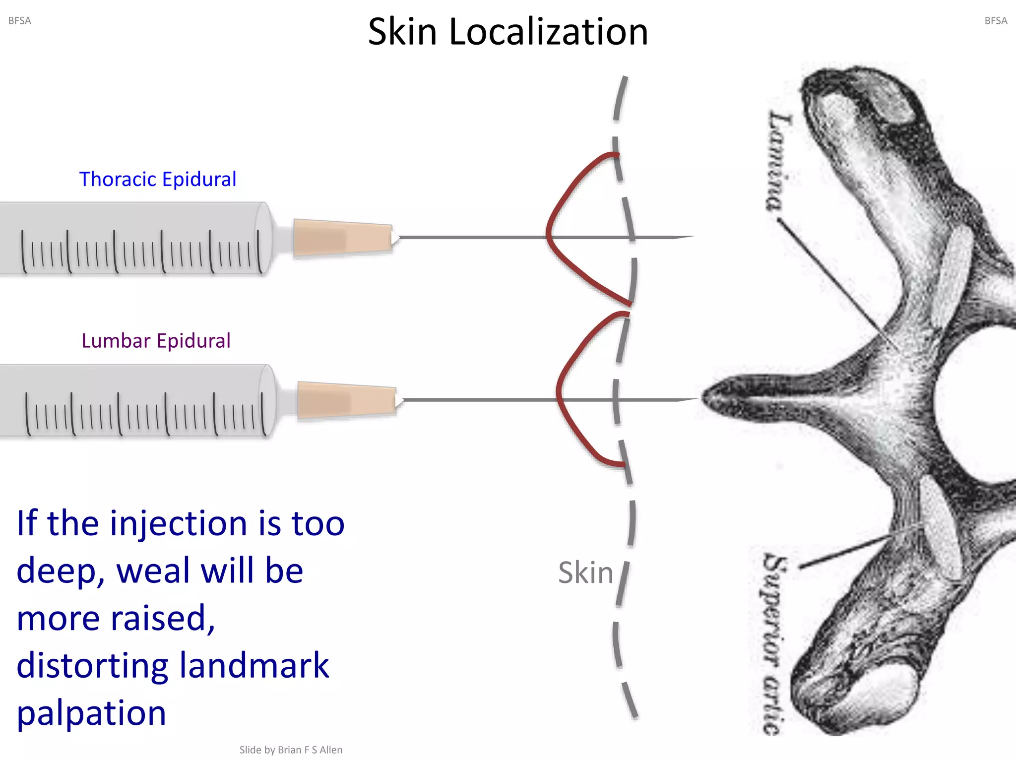Neuraxial and Truncal Regional Anesthesia | PPTX