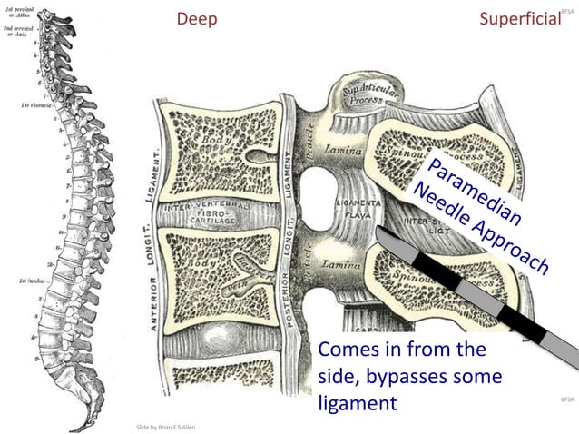Neuraxial and Truncal Regional Anesthesia | PPTX