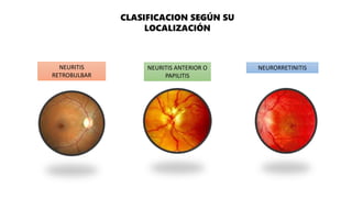 NEURITIS ÓPTICA.pptx
