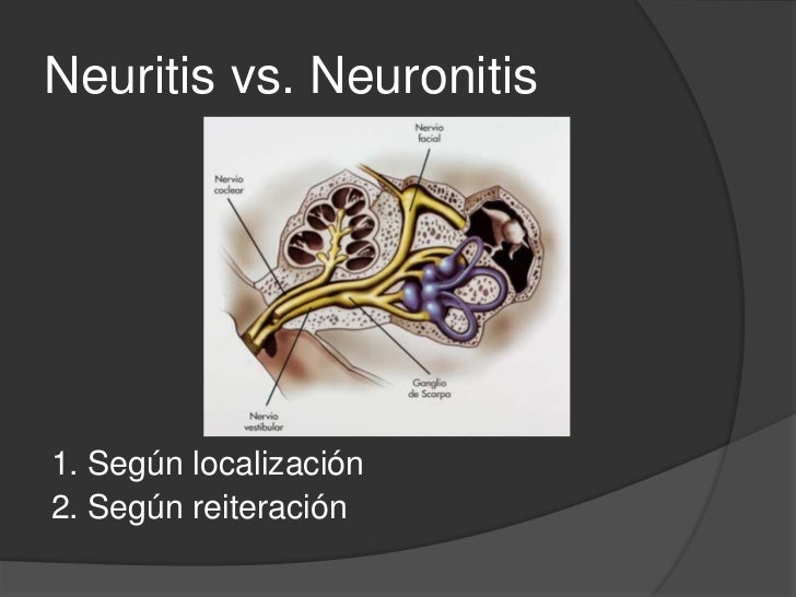 Neuritis y neuronitis vestibular