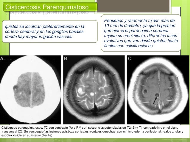 Neurocisticercosis Imagenología