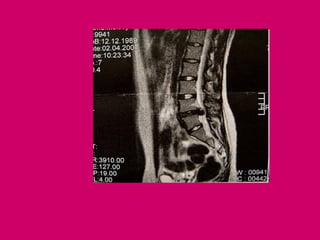 Neuro clinics 58 hypo-reflexia | PPT