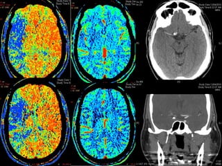 Ken Faulder: Clot Retrieval and the Future of Stroke | PDF