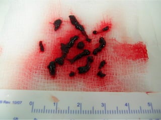 Ken Faulder: Clot Retrieval and the Future of Stroke | PDF