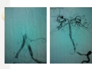 Ken Faulder: Clot Retrieval and the Future of Stroke | PDF