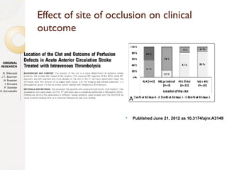Ken Faulder: Clot Retrieval and the Future of Stroke | PDF