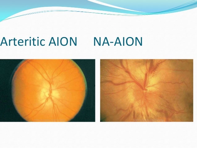 Neuro ophthalmological diagnoses you can’t afford to miss