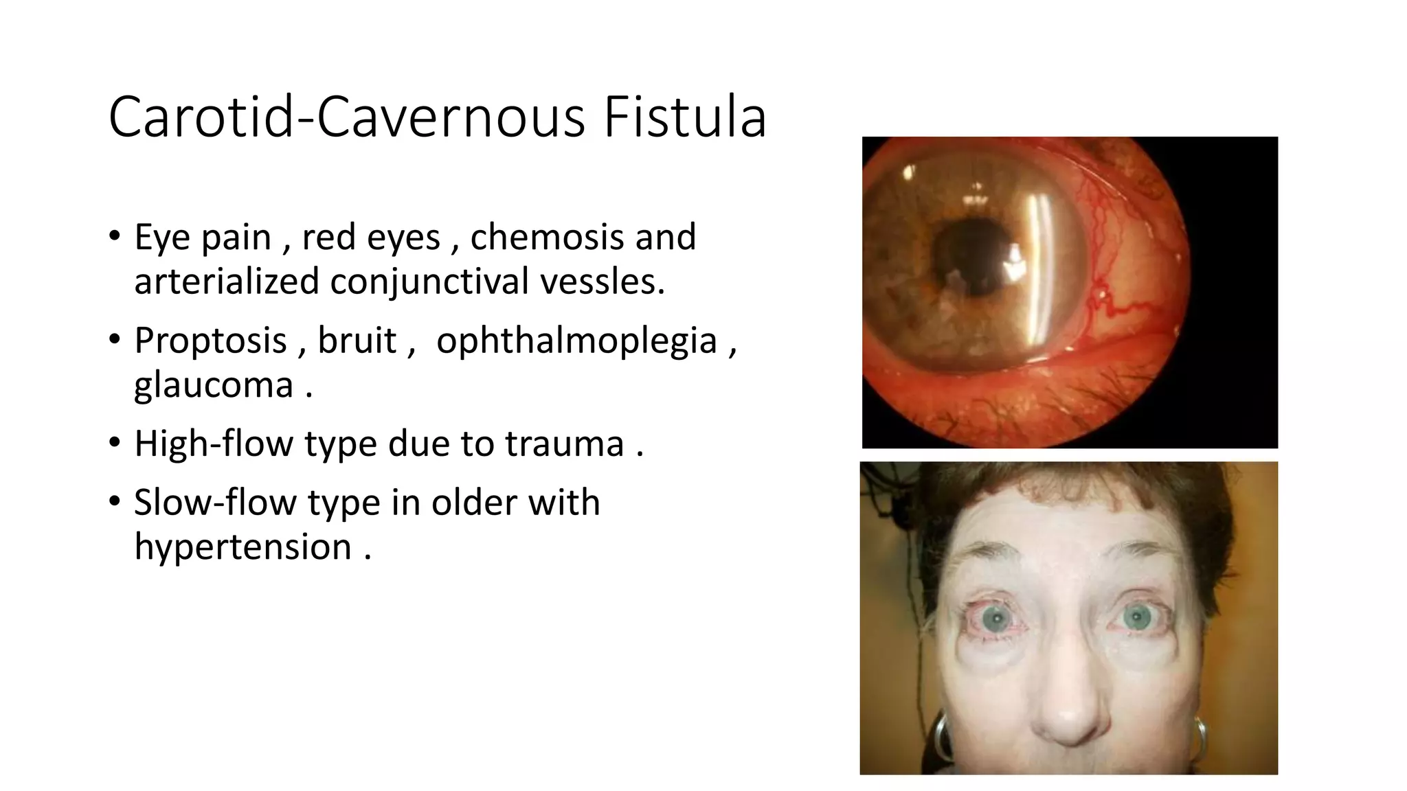 Neuro ophthalmologic causes of headache | PPTX