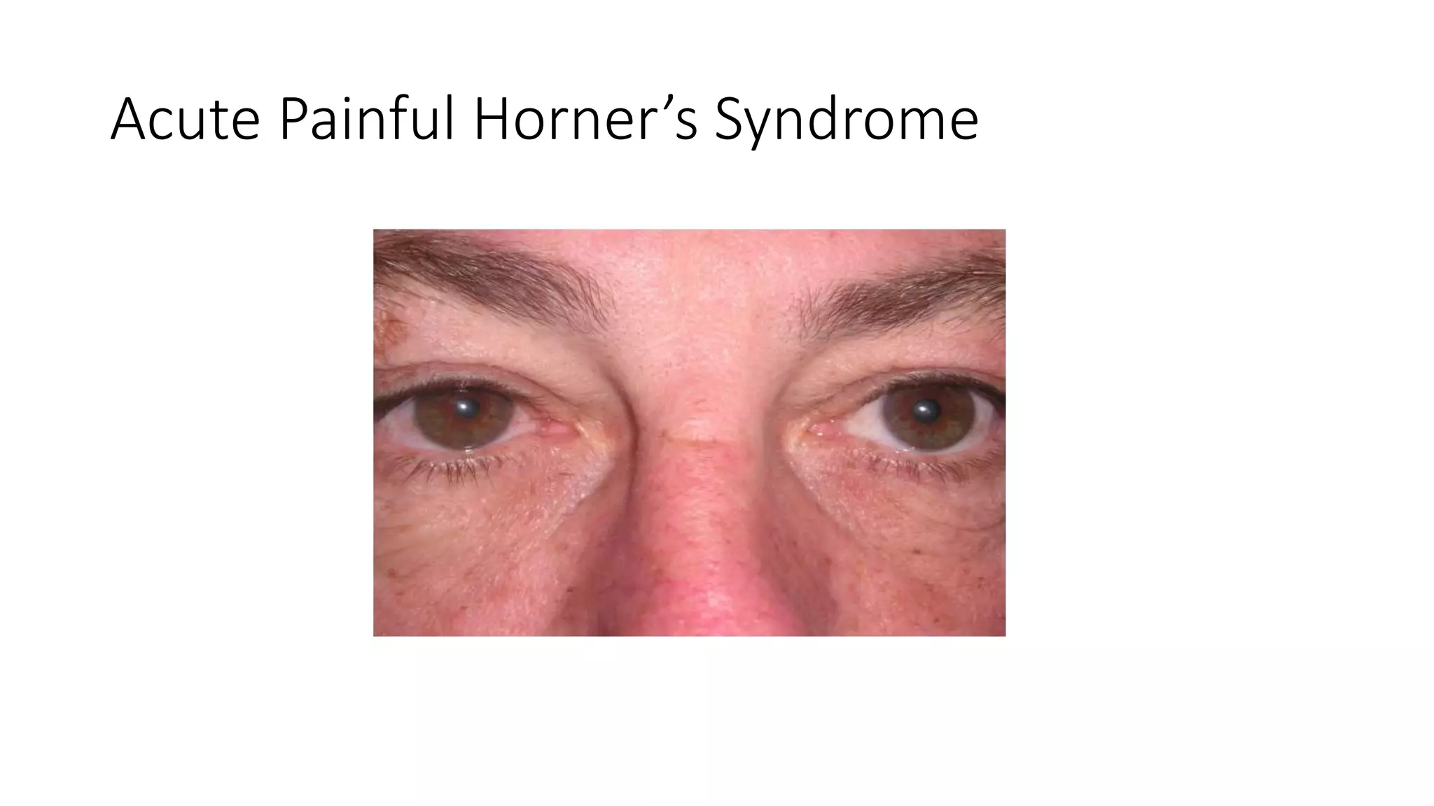 Neuro ophthalmologic causes of headache | PPTX