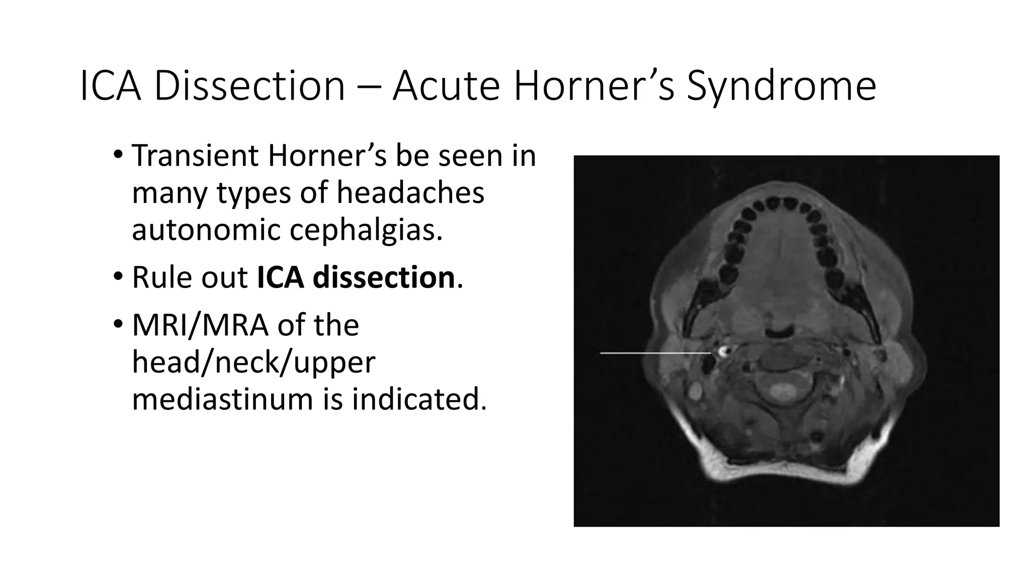 Neuro ophthalmologic causes of headache | PPTX