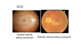 Neuro ophthalmologic causes of headache | PPTX