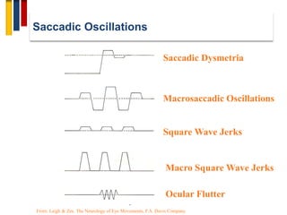 Neuro ophthalomology of Multiple sclerosis | PPT