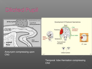 Neuro-opthalmology | PPT