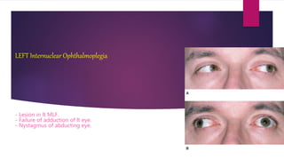 Neuro opthalmology | PPT