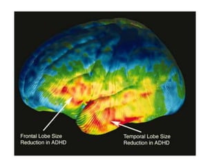 Neuroanatomy of adhd | PPTX | Brain and Nervous System Disorders ...