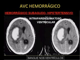 Neurorradiologia AVC isquêmico e hemorrágico