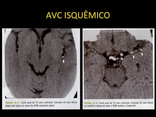 Neurorradiologia AVC isquêmico e hemorrágico | PPT