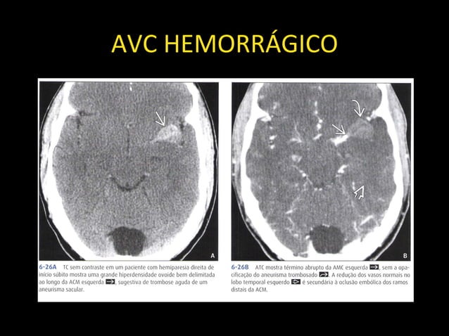 Neurorradiologia AVC isquêmico e hemorrágico