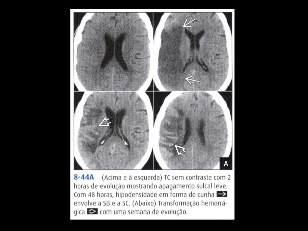 Neurorradiologia AVC isquêmico e hemorrágico
