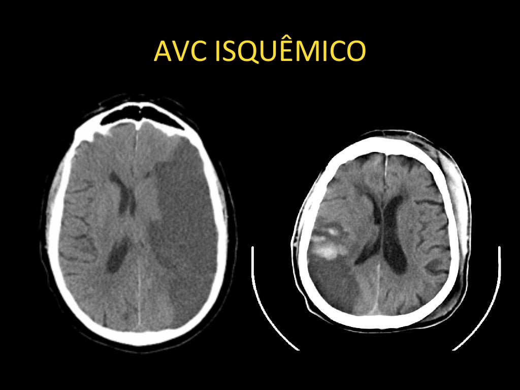 Neurorradiologia AVC isquêmico e hemorrágico