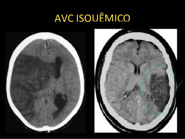 Neurorradiologia AVC isquêmico e hemorrágico