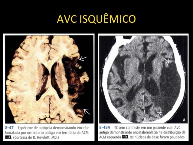 Neurorradiologia AVC isquêmico e hemorrágico