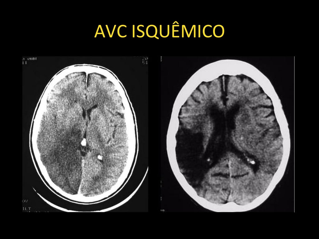 Neurorradiologia AVC isquêmico e hemorrágico