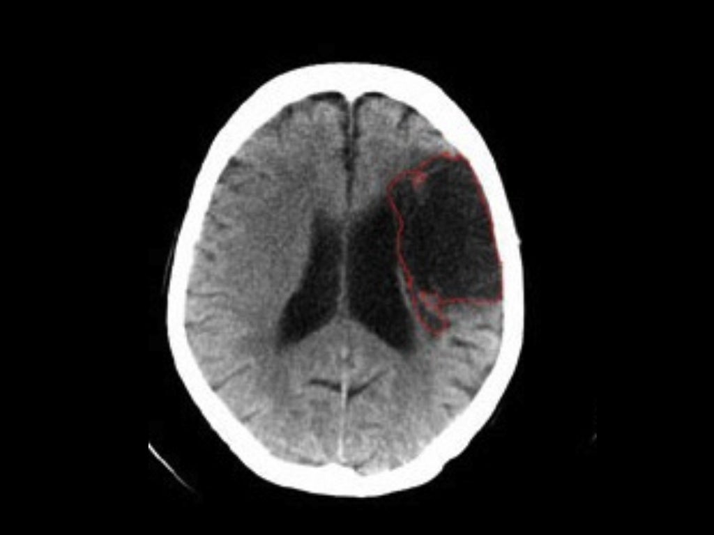 Neurorradiologia AVC isquêmico e hemorrágico