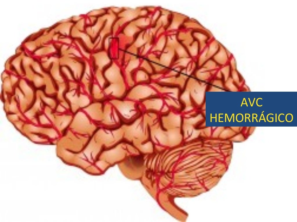 Neurorradiologia AVC isquêmico e hemorrágico