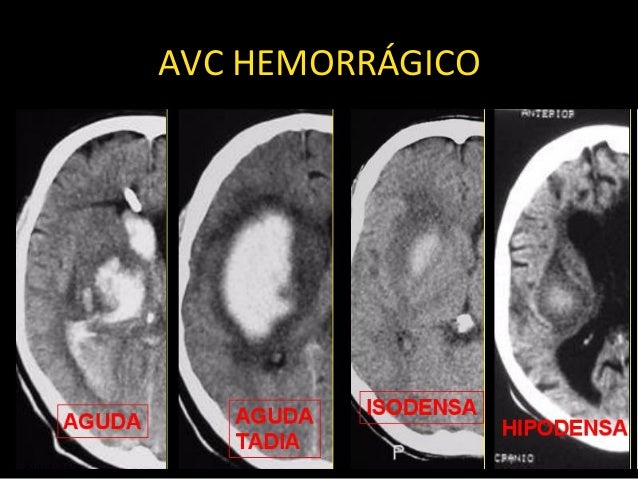 Neurorradiologia AVC isquêmico e hemorrágico