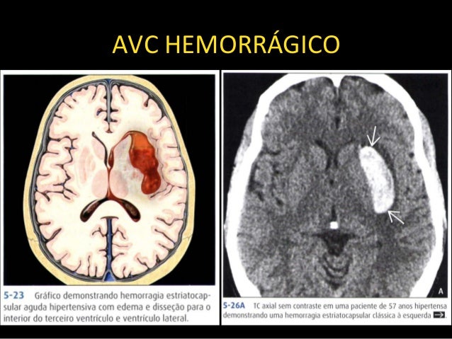 Neurorradiologia AVC isquêmico e hemorrágico