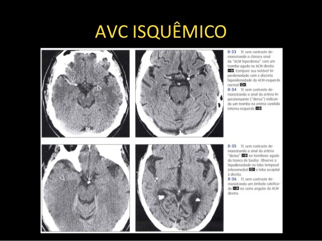 Neurorradiologia AVC isquêmico e hemorrágico