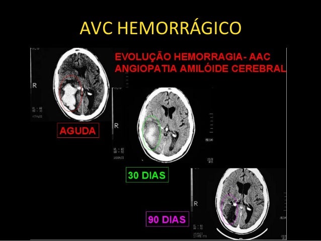 Neurorradiologia AVC isquêmico e hemorrágico