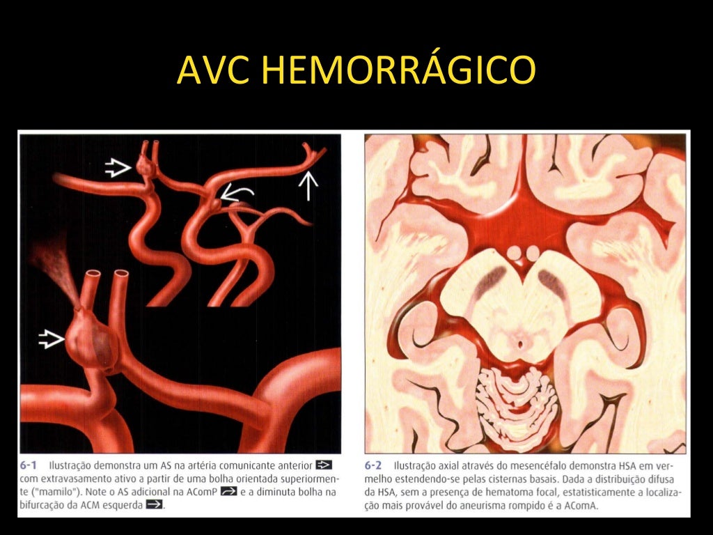 Neurorradiologia AVC isquêmico e hemorrágico