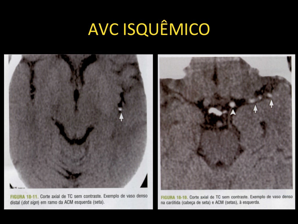 Neurorradiologia AVC isquêmico e hemorrágico