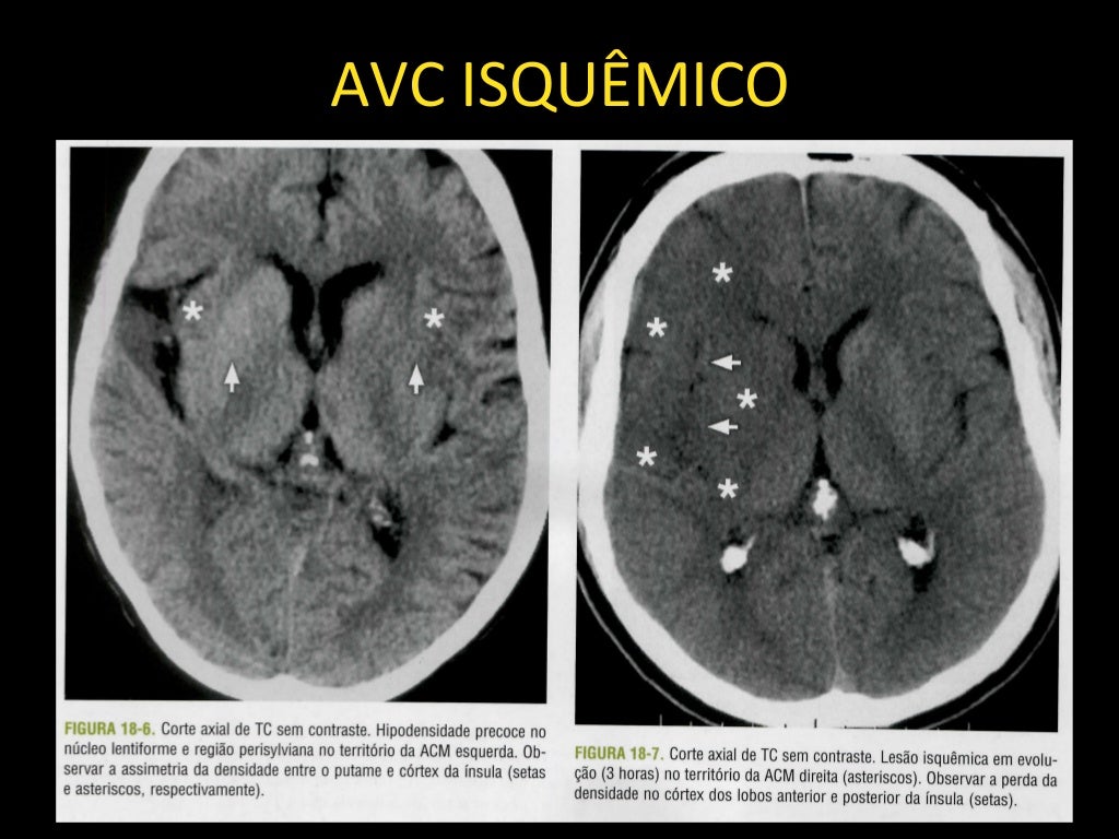 Neurorradiologia AVC isquêmico e hemorrágico