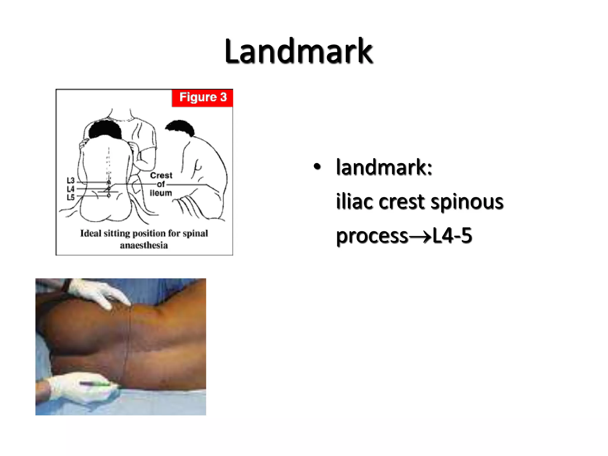 Neuraxial anesthesia | PPTX