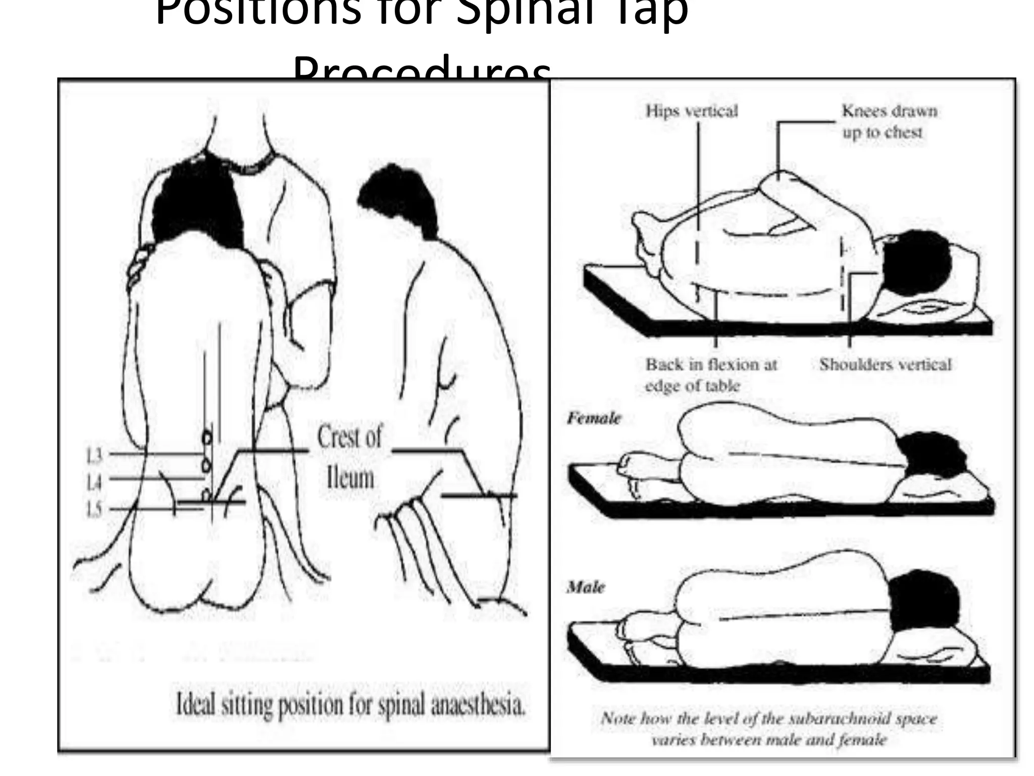 Neuraxial anesthesia | PPTX