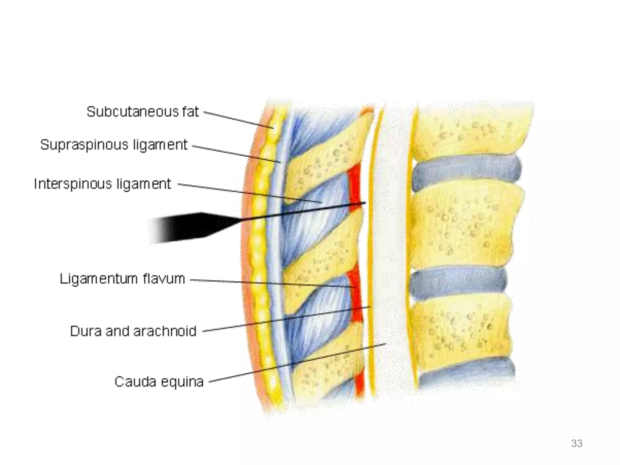 Neuraxial anesthesia | PPTX