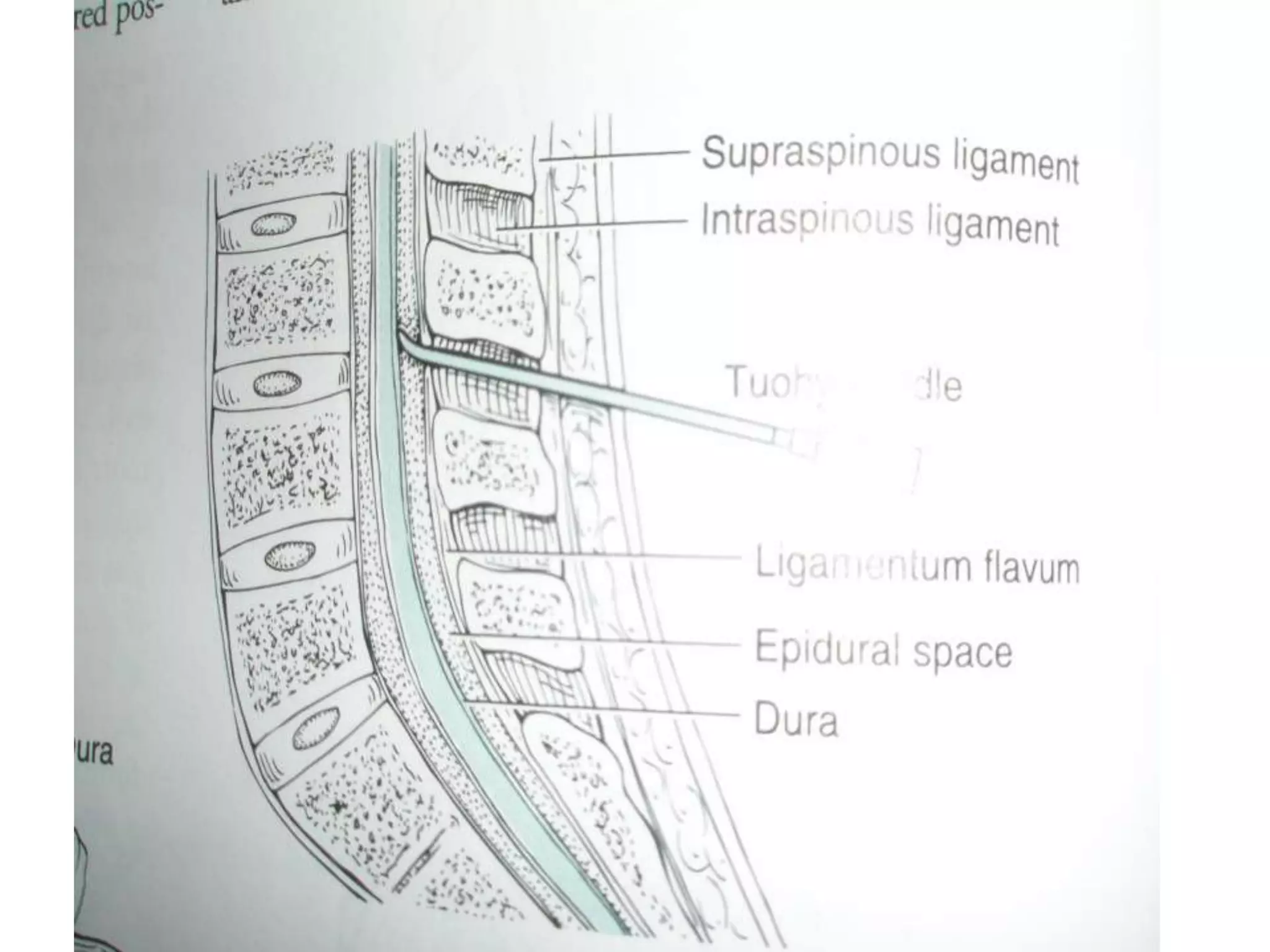Neuraxial anesthesia | PPTX
