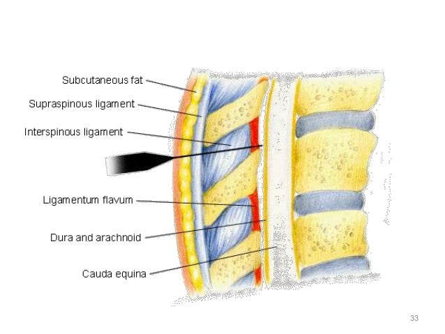 Neuraxial anesthesia