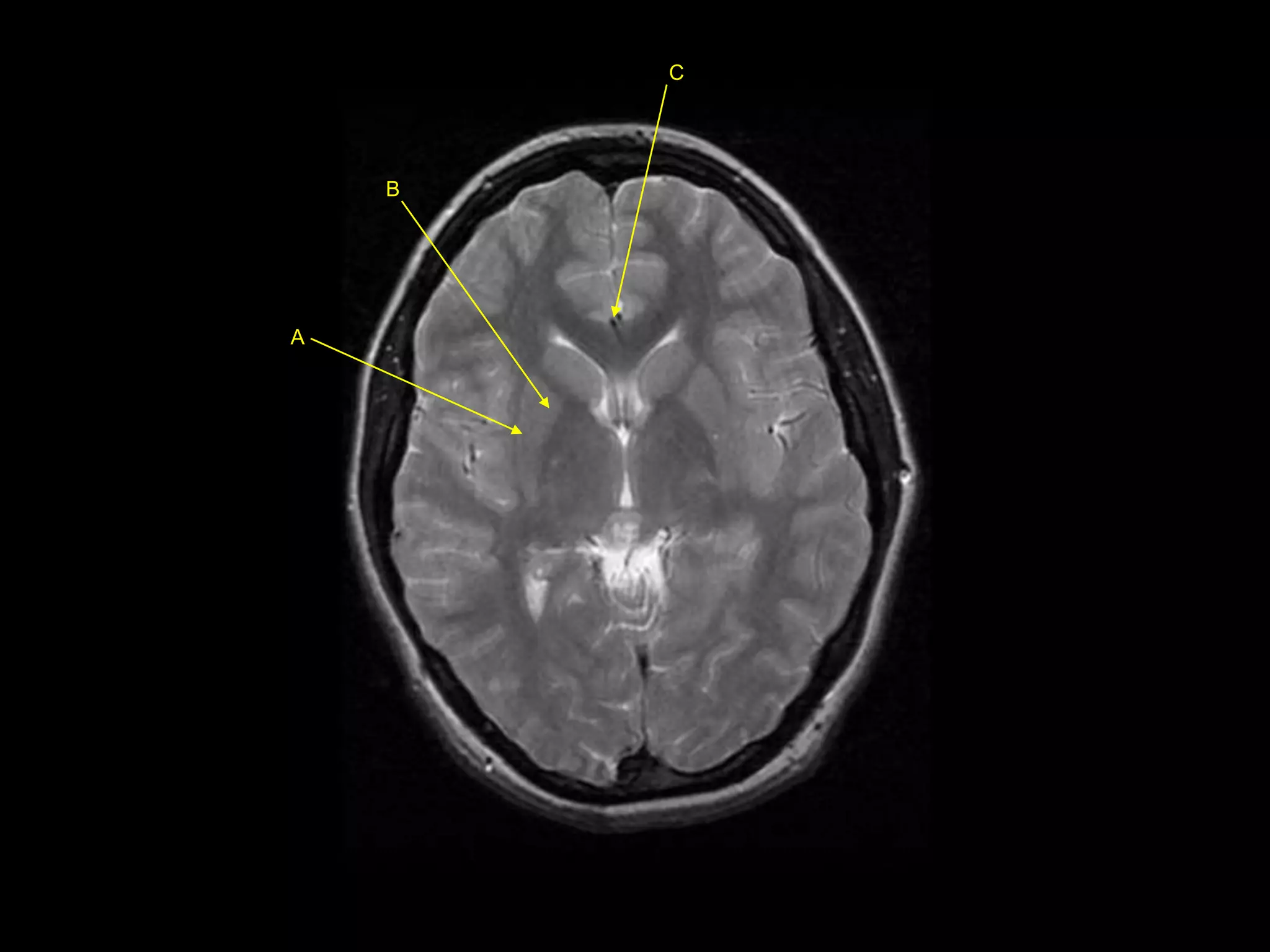 MRI BRAIN AXIAL IMAGE WITH LABELING | PPT