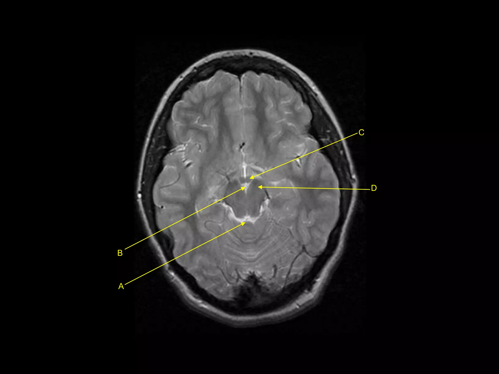 MRI BRAIN AXIAL IMAGE WITH LABELING | PPT