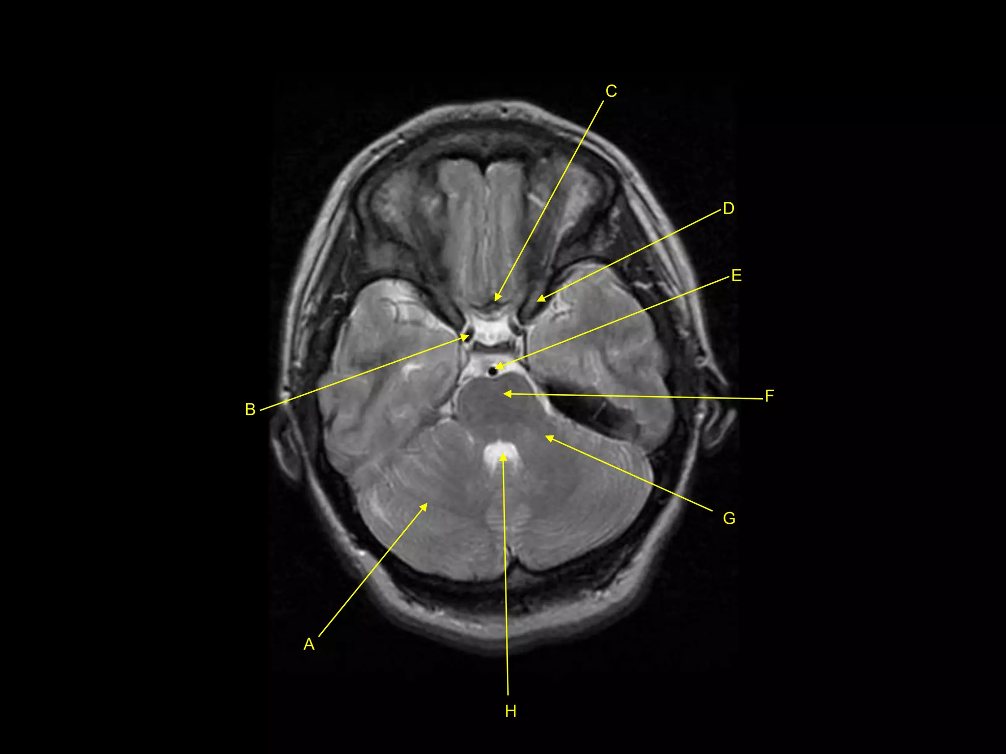 MRI BRAIN AXIAL IMAGE WITH LABELING | PPT