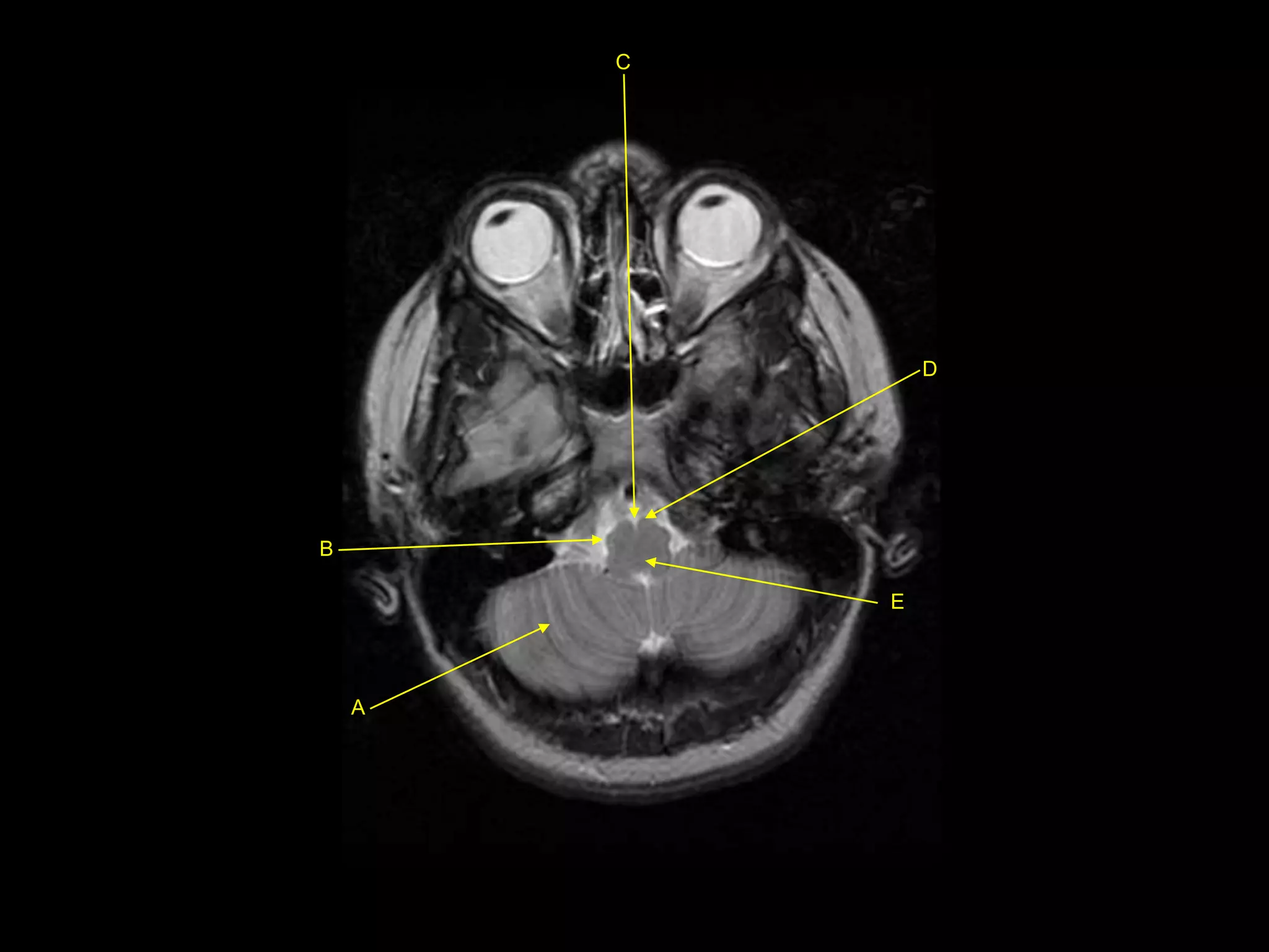 MRI BRAIN AXIAL IMAGE WITH LABELING | PPT