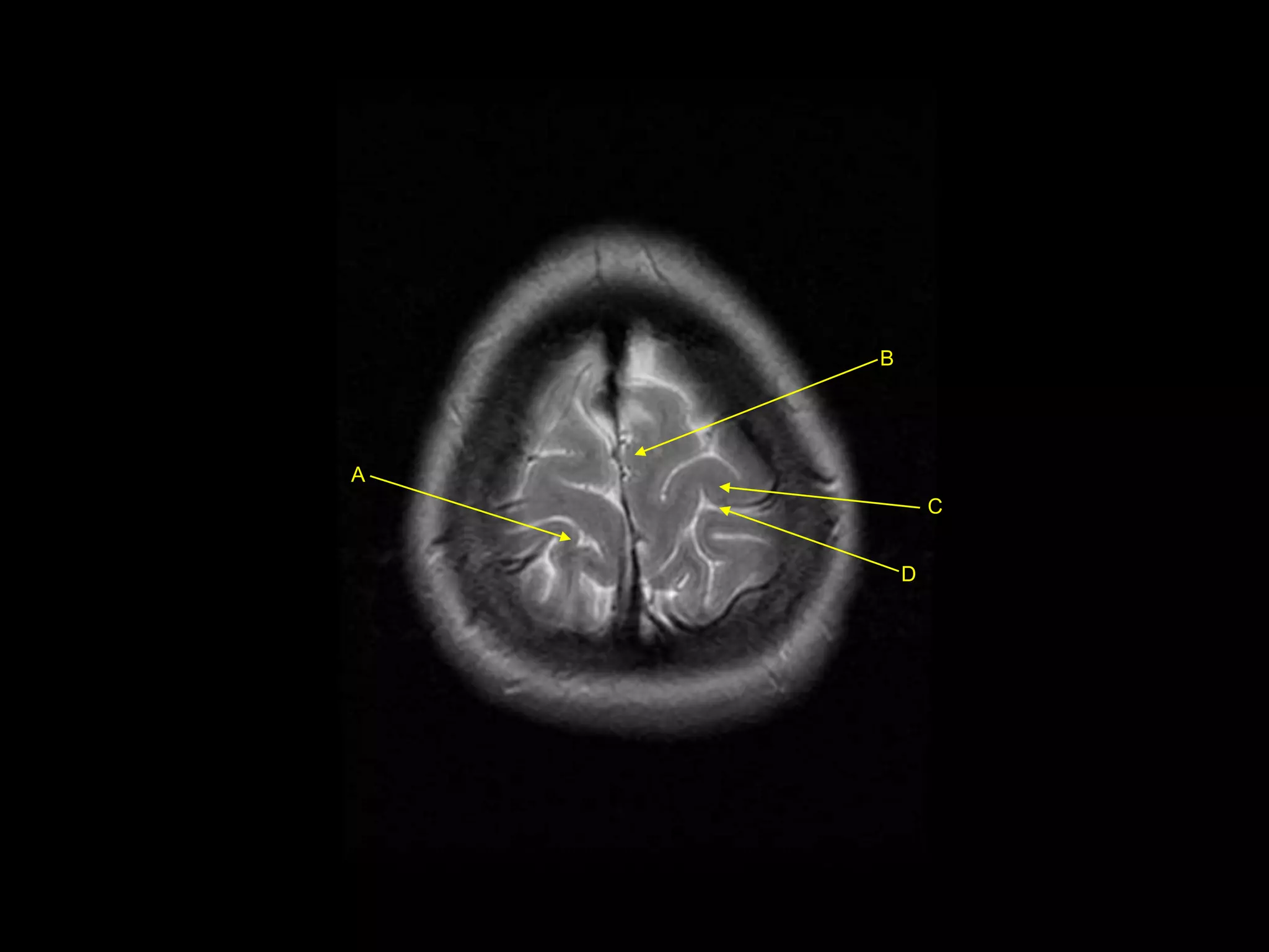 MRI BRAIN AXIAL IMAGE WITH LABELING | PPT