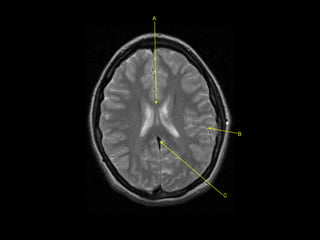MRI BRAIN AXIAL IMAGE WITH LABELING | PPT