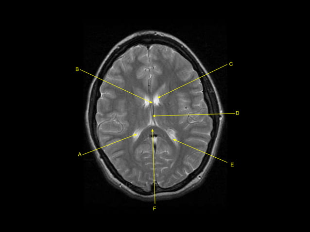 MRI BRAIN AXIAL IMAGE WITH LABELING | PPT
